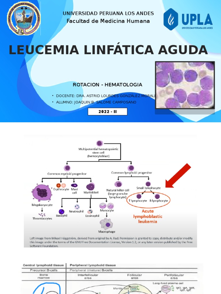 Leucemia Linfatica Aguda | PDF | Leucemia | Enfermedades y trastornos
