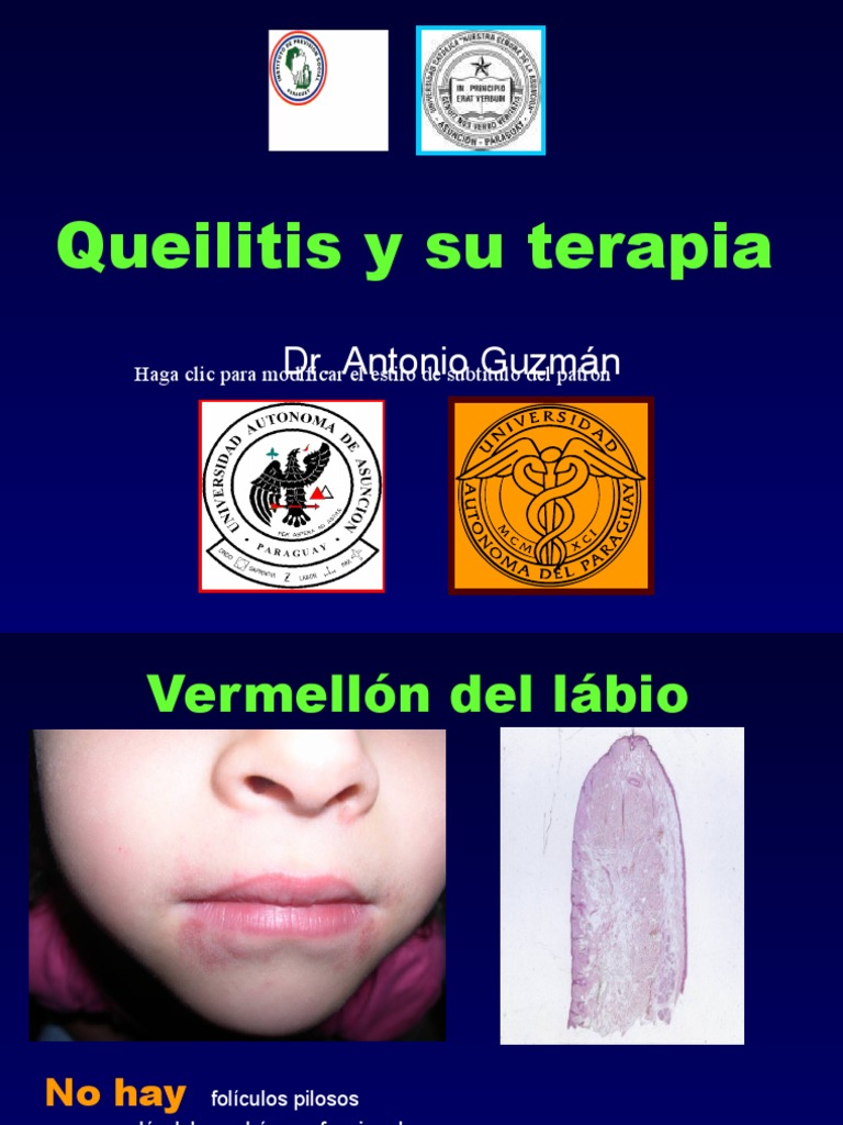 Queilitis: Tipos y Tratamientos Efectivos | PDF | Enfermedad de Crohn ...