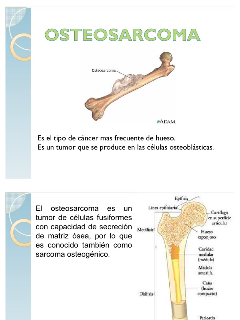 Osteosarcoma | PDF