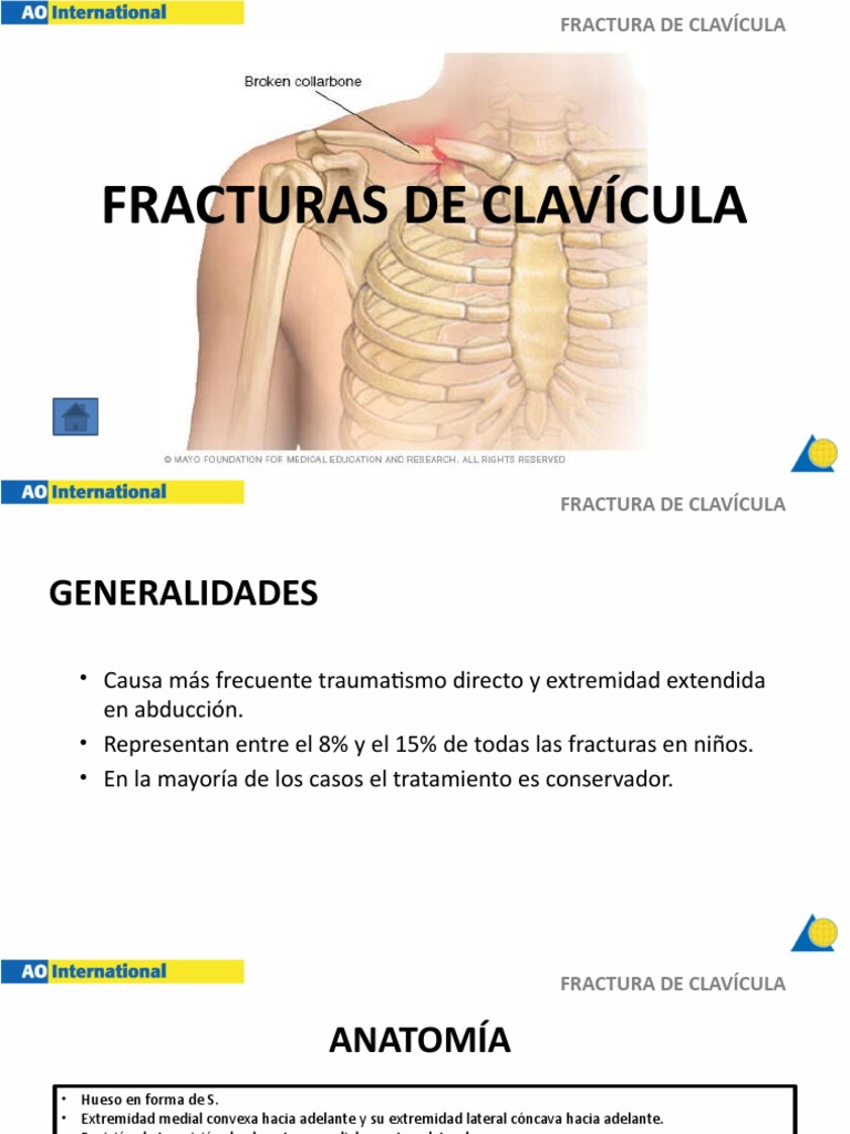 Fracturas de clavícula: anatomía, clasificación, tratamiento y ...