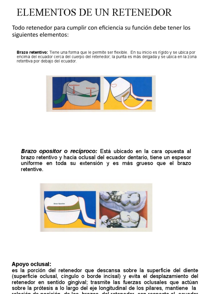 Elementos de Un Retenedor - Tipos de Retenedor | PDF | Dentadura postiza