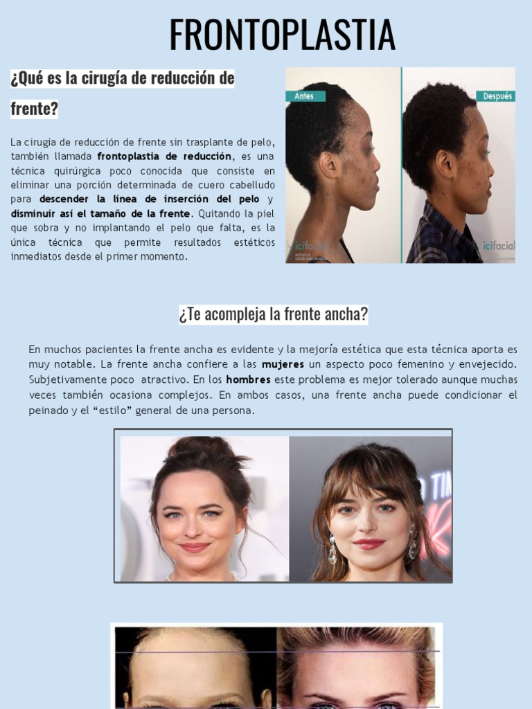 Frontoplastia-Aleja Ávila | PDF | Cirugía | Pelo