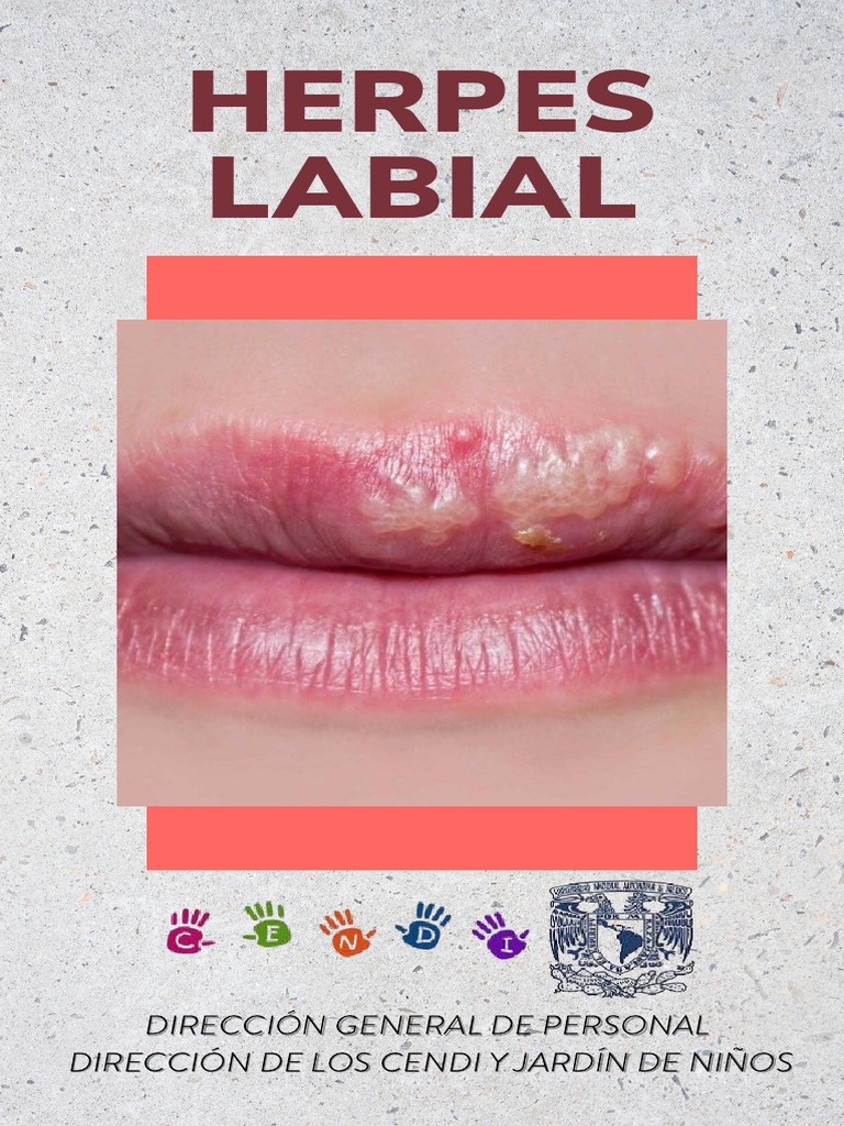 Fases y tratamiento del herpes labial | PDF | Herpes Simple | Virus