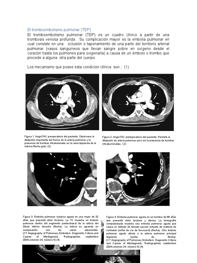 Trabajo TC | PDF | Embolia | Trombo