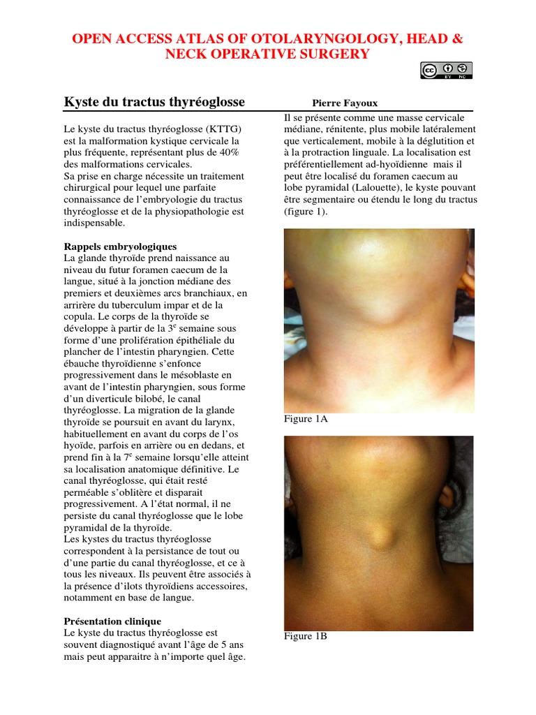 Kyste du tractus thyréoglosse : prise en charge | PDF | Thyroïde ...
