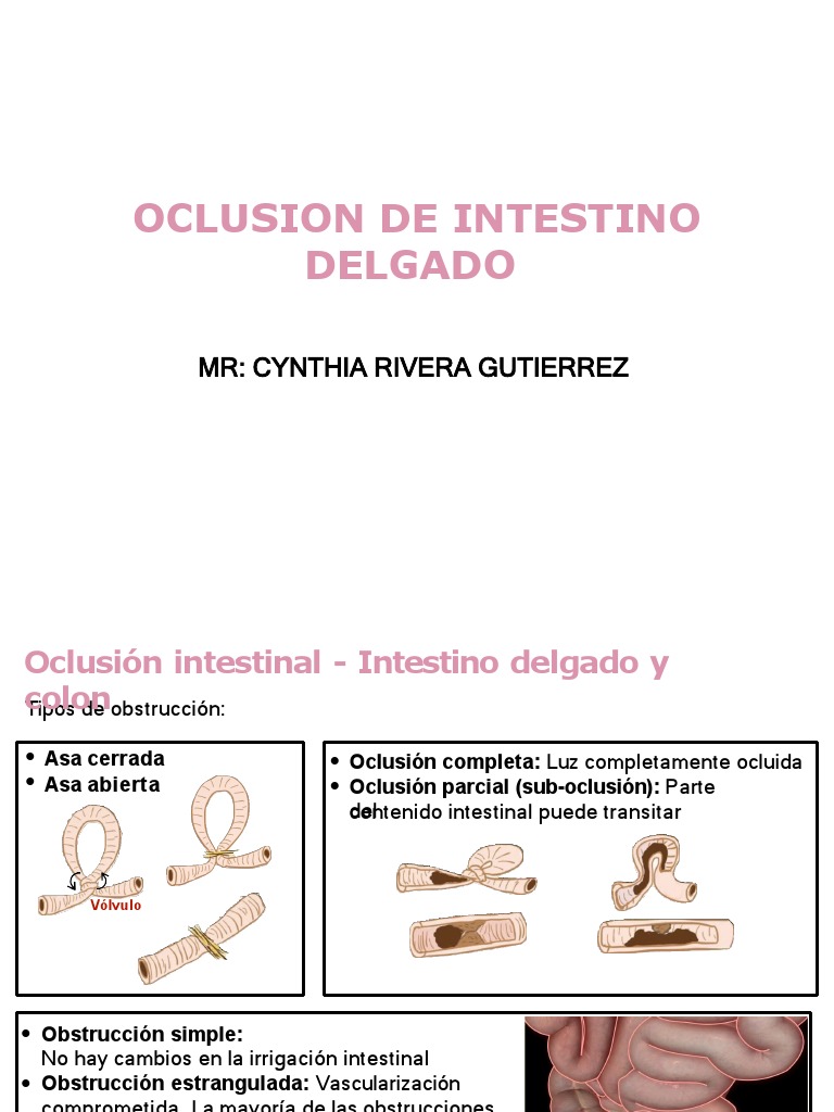 Signos Radiológicos de Obstrucción Intestinal | PDF | Órgano (anatomía ...
