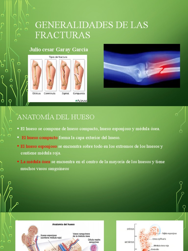 Generalidades sobre fracturas óseas | PDF | Hueso | Anatomía