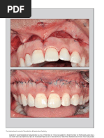Distal Wedge Procedure Techniques | PDF | Periodontology | Face