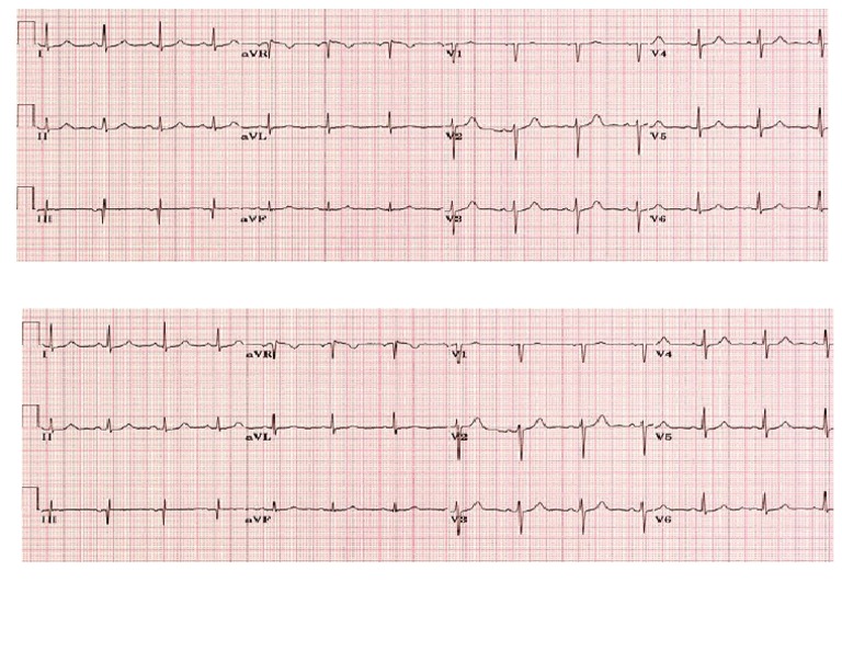 Gambar Ekg Normal 2 | PDF