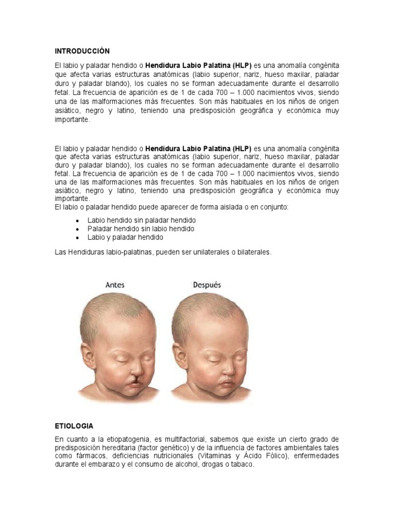 Labio y Paladar Hendido | PDF | Ortodoncia | Medicina CLINICA