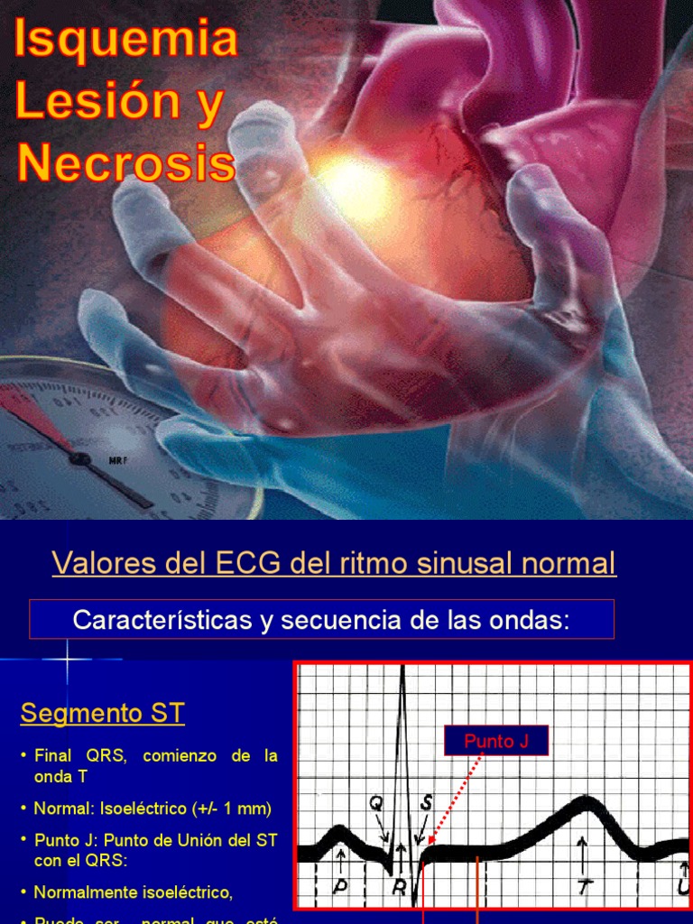 Isquemia, Lesion y Necrosis | PDF | Electrocardiografia | Infarto de ...