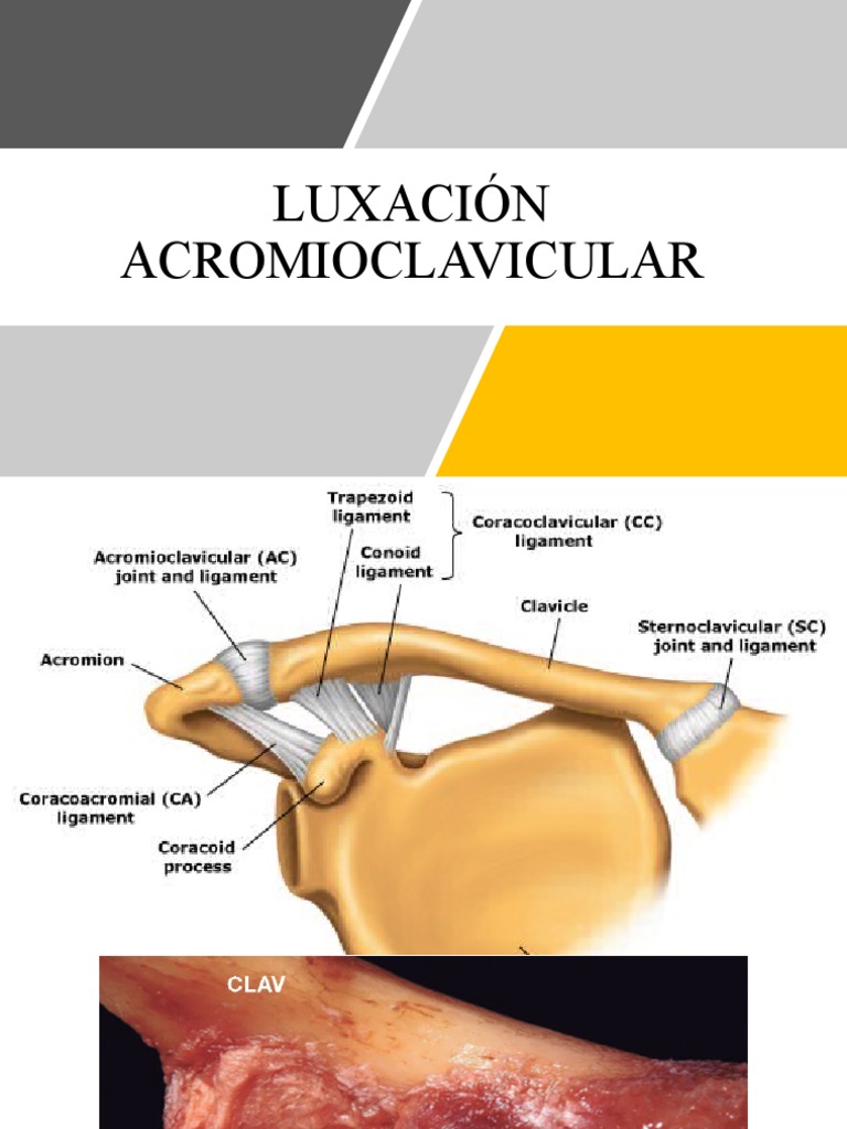 Luxación Acromioclavicular | PDF | Hombro | Anatomía