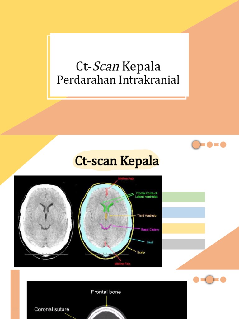 Ct-Scan Kepala untuk Diagnosis Perdarahan Intrakrannial | PDF