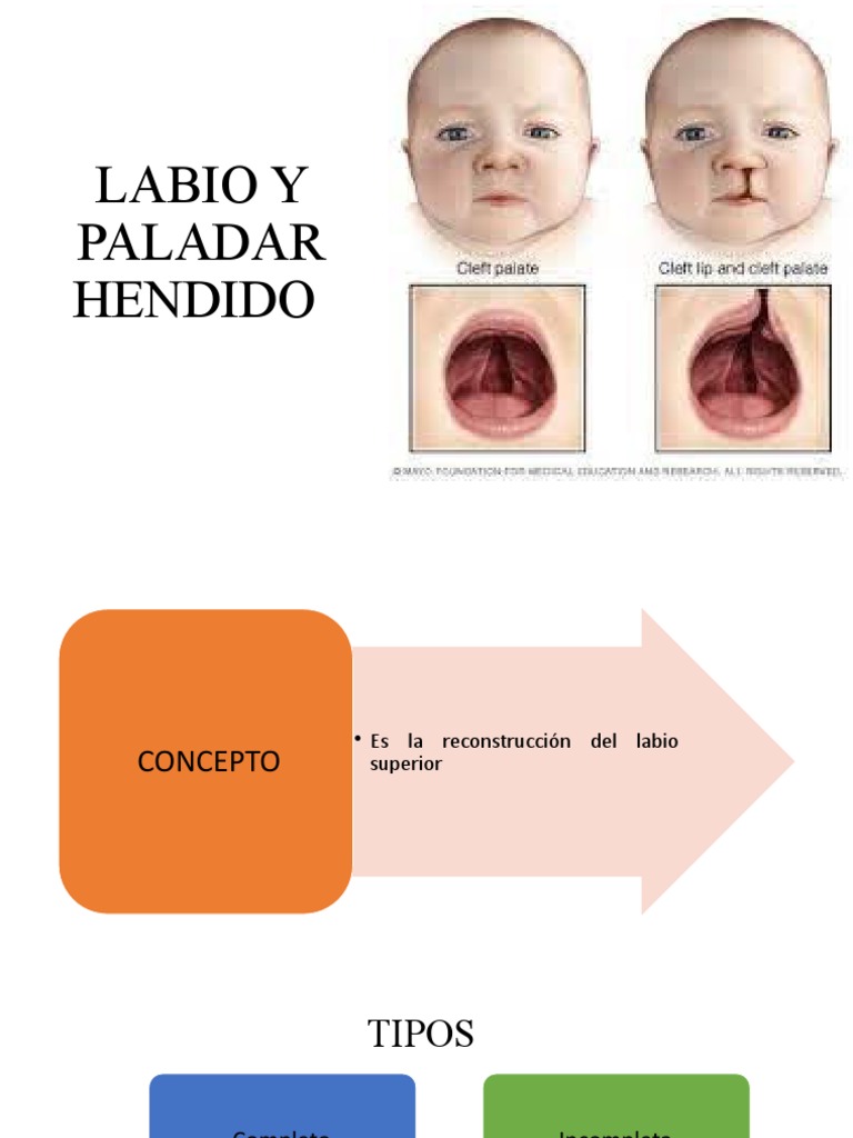 Labio y Paladar Hendido | PDF | Cirugía | Anatomía humana