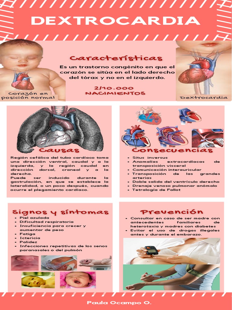 Dextrocardia: Definición y Consecuencias | PDF | Salud y bienestar