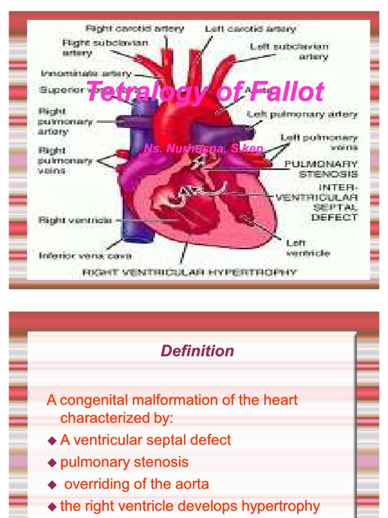 Tetralogy of Fallot | PDF | Congenital Heart Defect | Heart