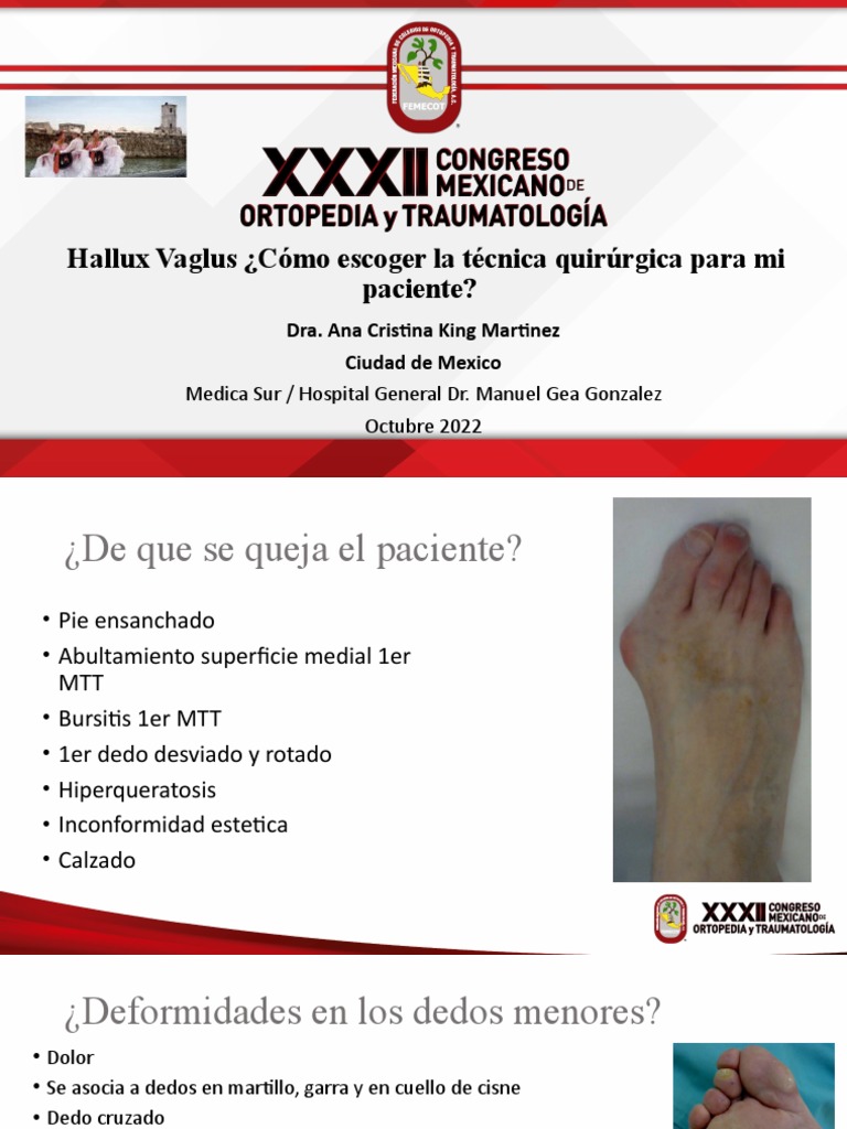 Hallux Valgus Escoger La Tecnica | PDF | Pie | Dedo del pie