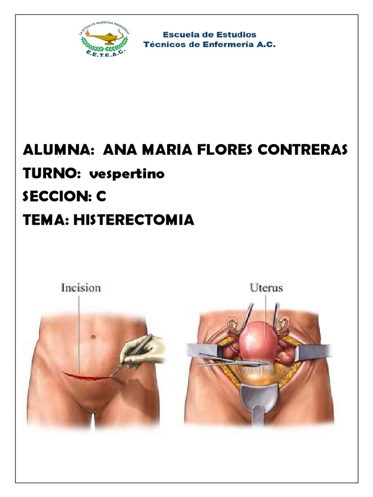 HISTERECTOMIA | PDF | Útero | Vagina