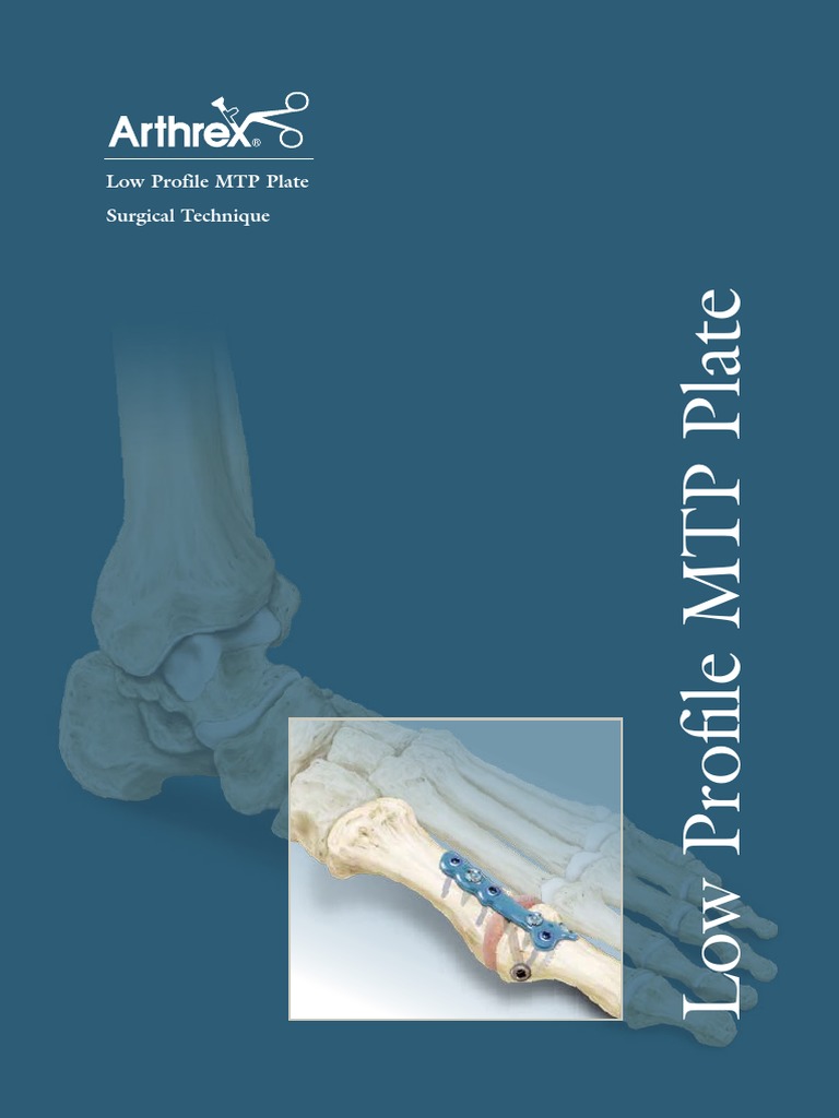Low Profile MTP Plate Surgical Technique: © 2012, Arthrex Inc. All ...