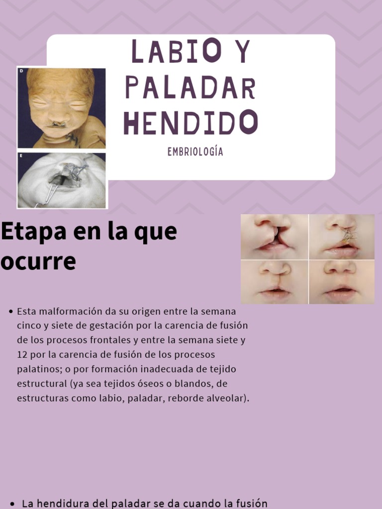 Embriología del Labio y Paladar Hendido | PDF | Medicina CLINICA ...