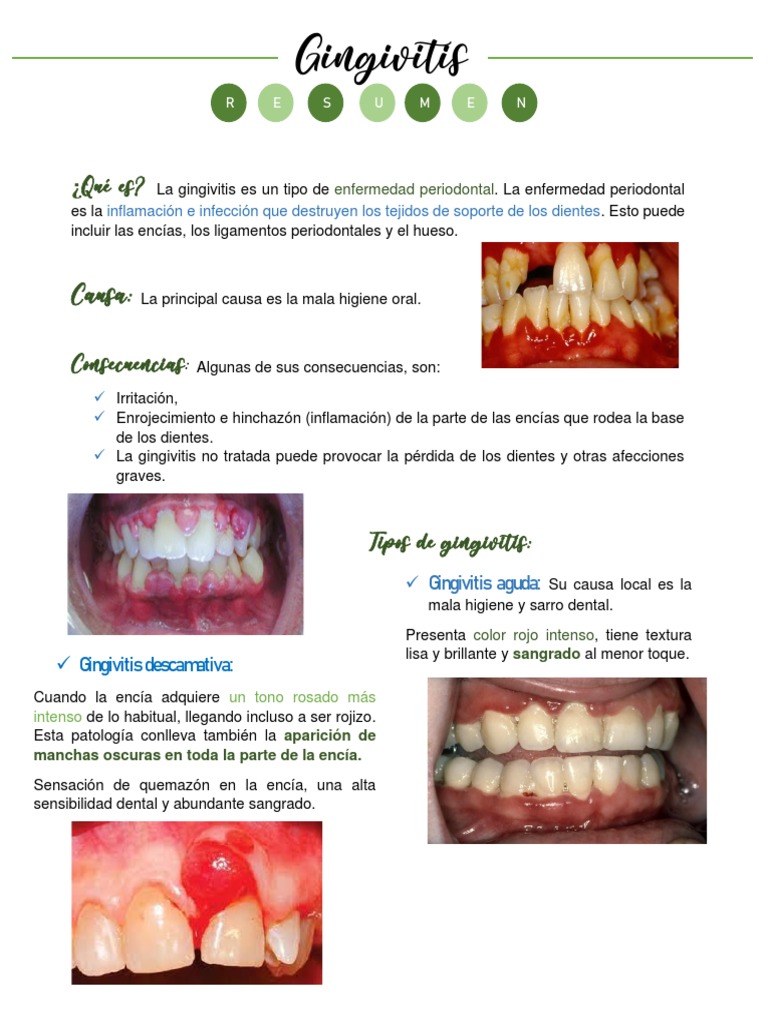 Gingivitis | PDF