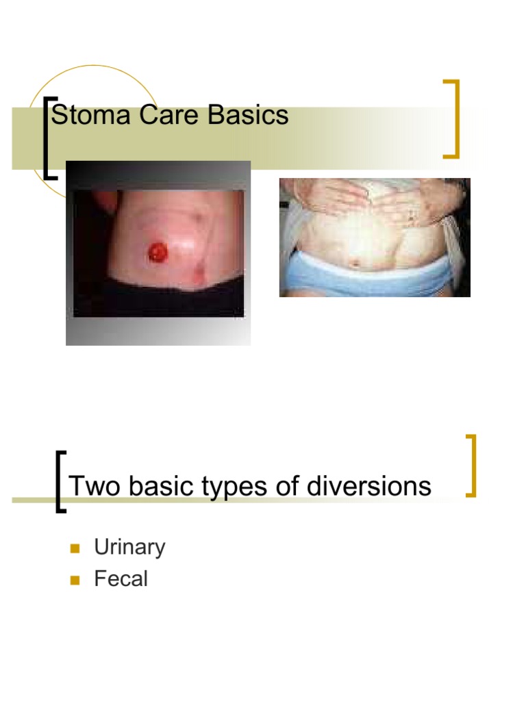 Stoma Care Basics | PDF | Digestive System | Gastroenterology