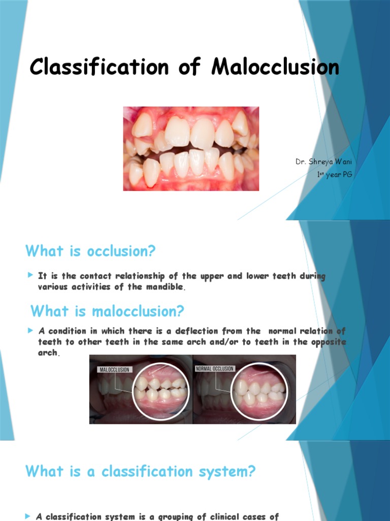 Classification of Malocclusion | PDF