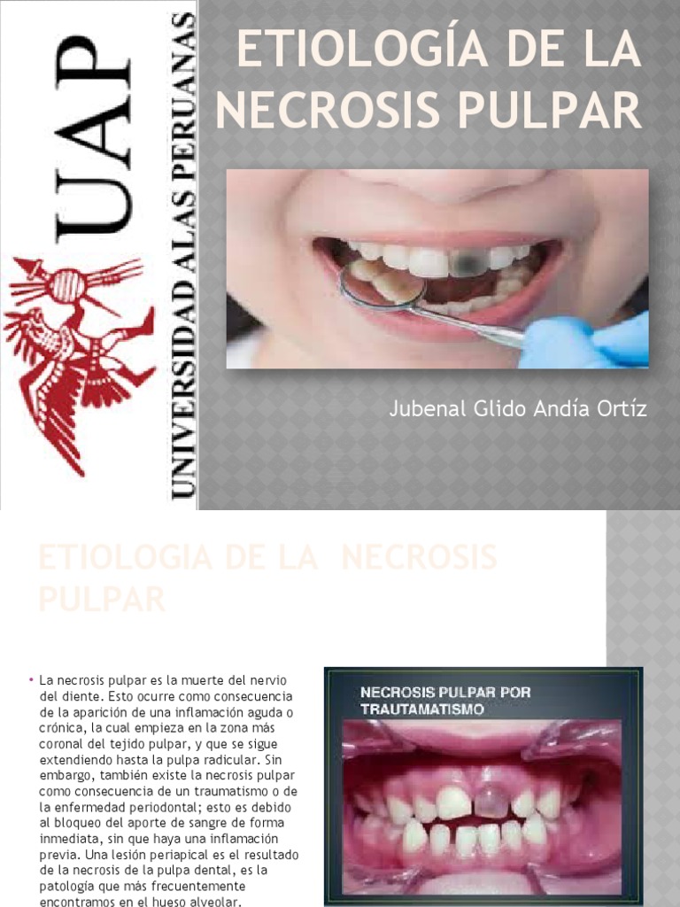 Necrosis Pulpar Glido-1 | PDF | Odontología | Medicina