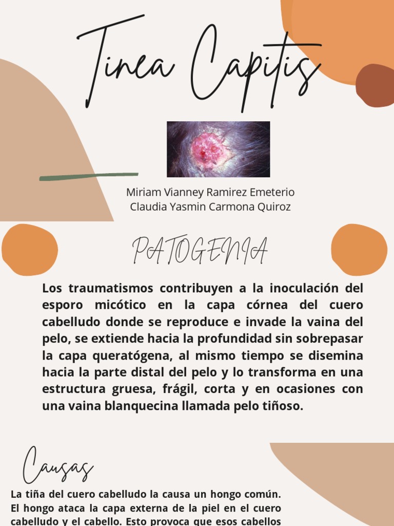 Exposición Tinea Capitis | PDF