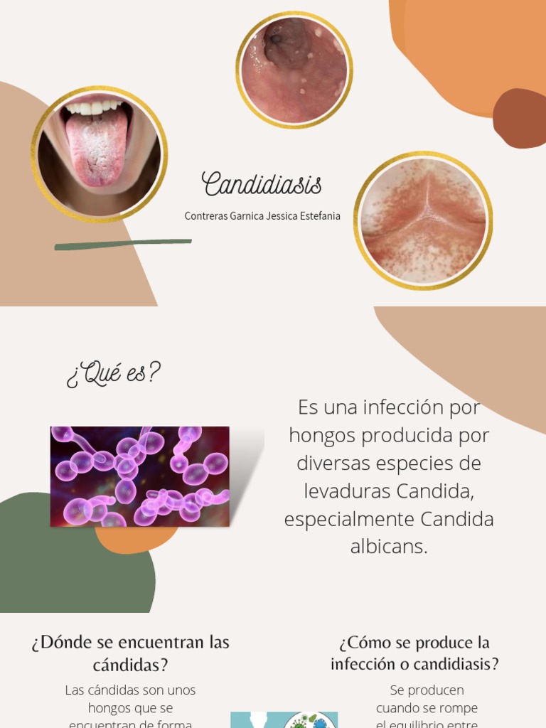 Candidiasis | PDF | Candidiasis | Medicina