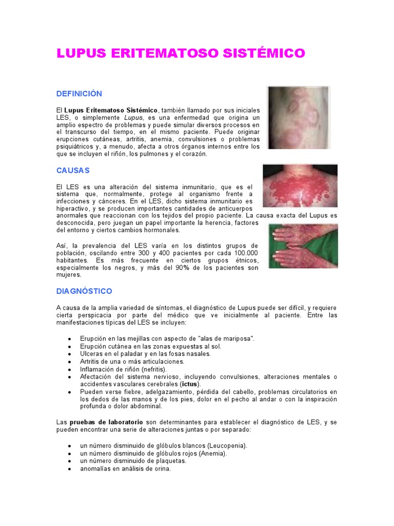 Lupus Eritematoso Sistémico | PDF | Especialidades Medicas | Medicina CLINICA