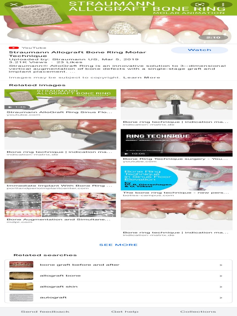 Bone Ring Technique - Google Search | PDF