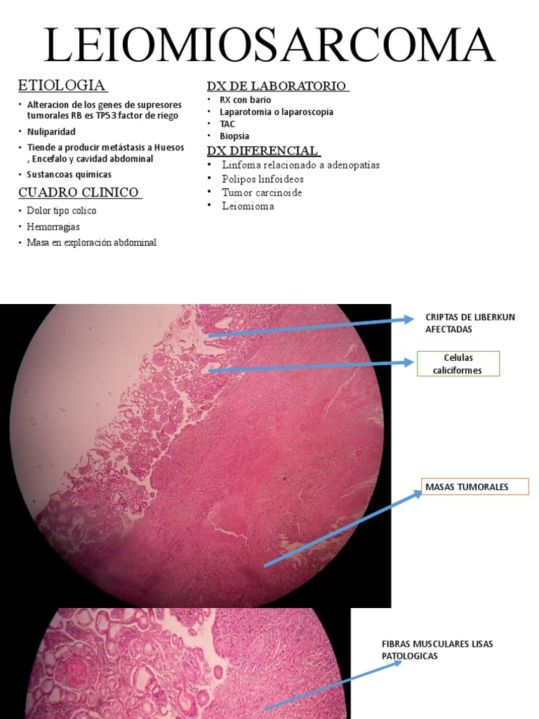LEIOMIOSARCOMA | PDF | Hueso | Neoplasias
