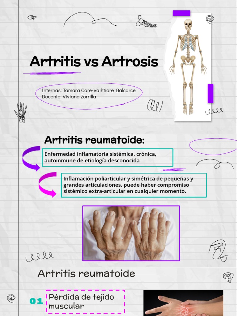 Artritis Vs Artrosis | PDF | Artritis Reumatoide | Osteoartritis