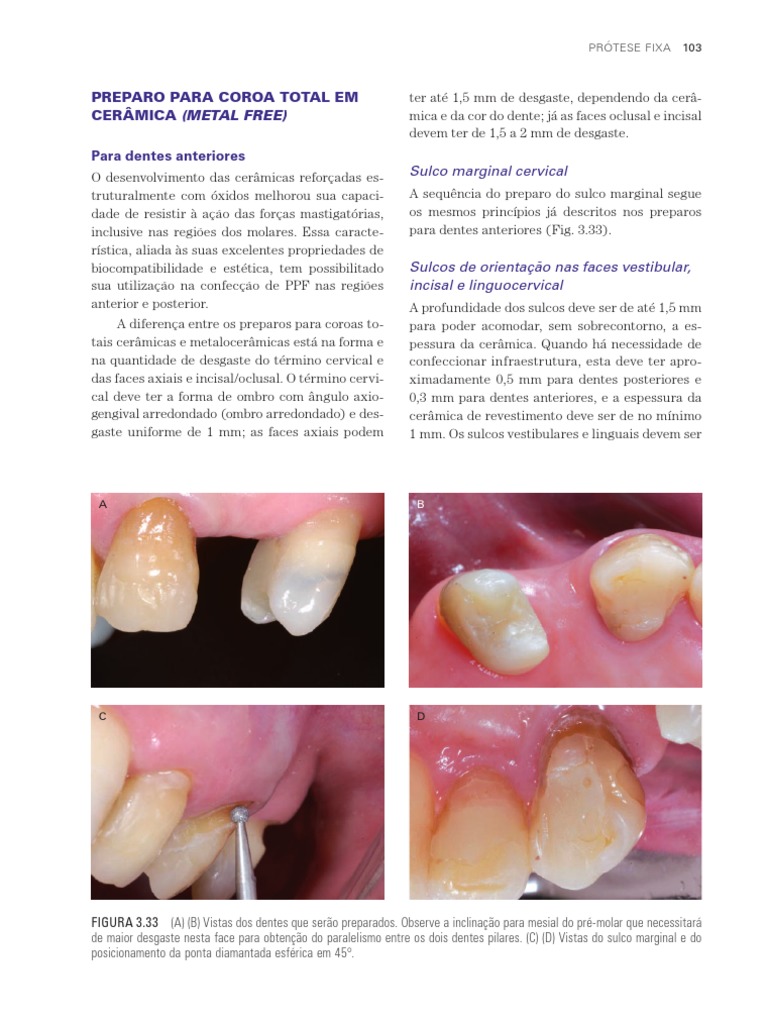PREPARO+PARA+COROA+TOTAL+EM+CER%C3%82MICA+-+ANTERIOR_1 | PDF | Dente