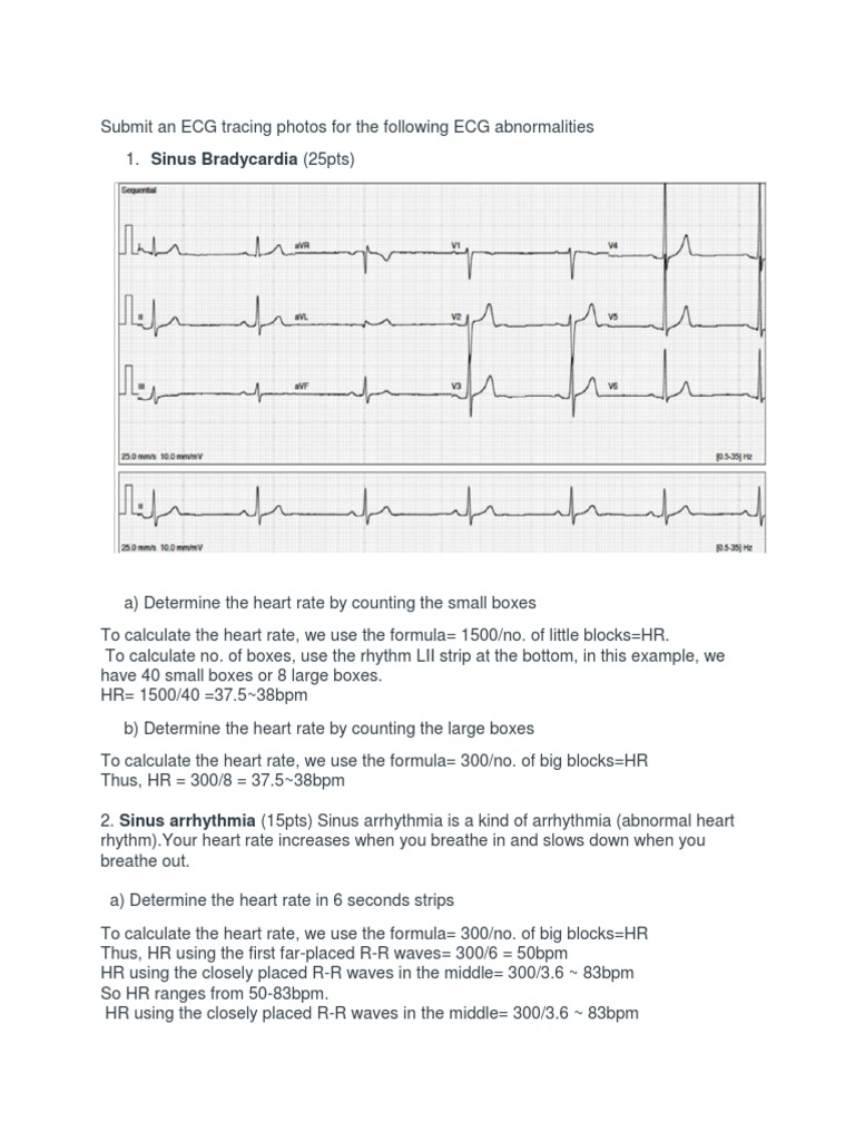 ECG Interpretation | PDF | Electrocardiography | Ventricle (Heart)
