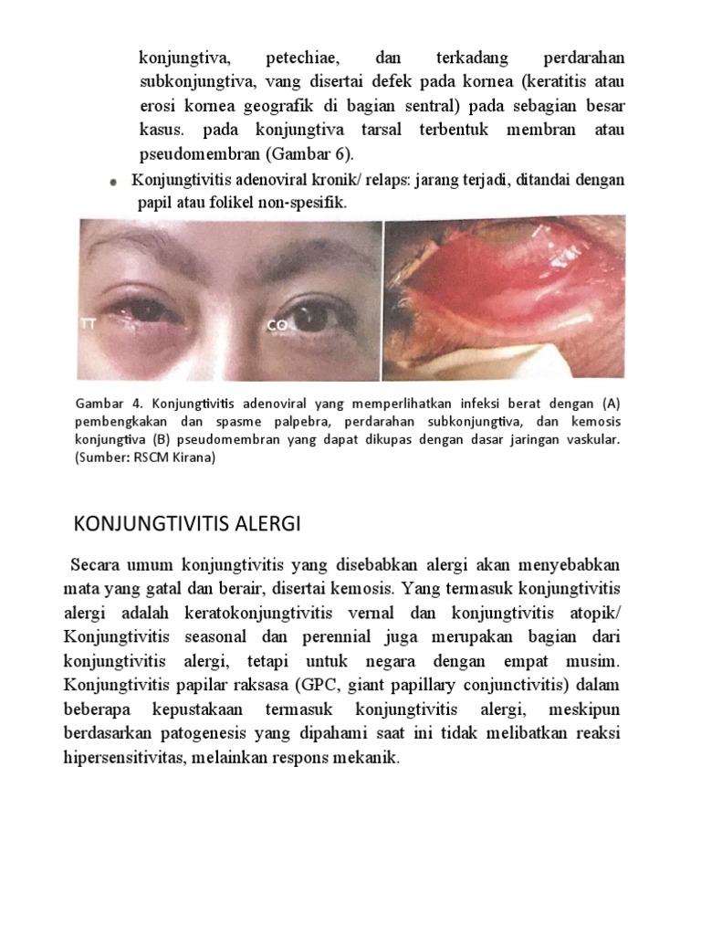 Konjungtivitis Alergi | PDF