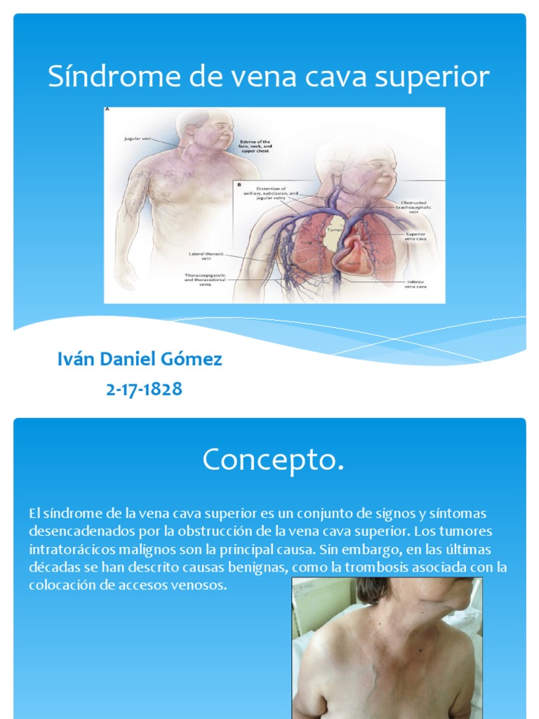 Síndrome de Vena Cava Superior | PDF | Cáncer | Vena