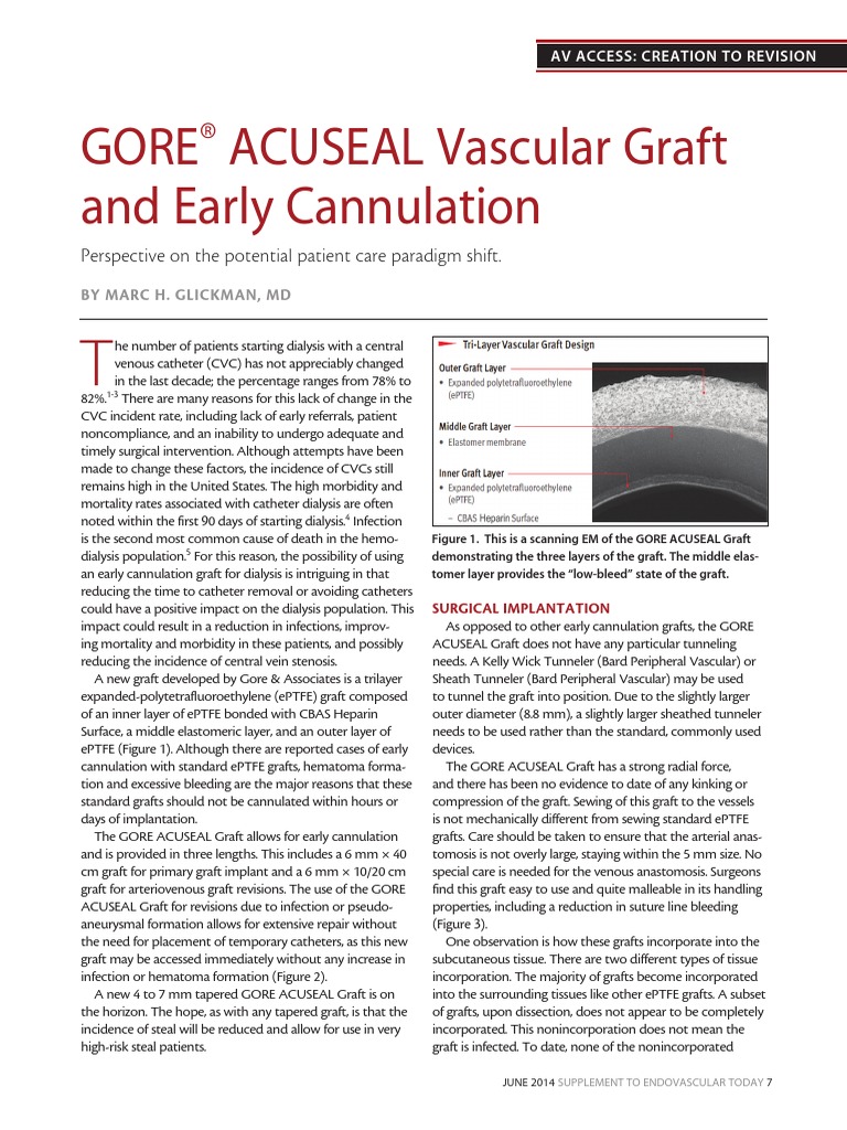 GORE® ACUSEAL Vascular Graft and Early Cannulation | PDF