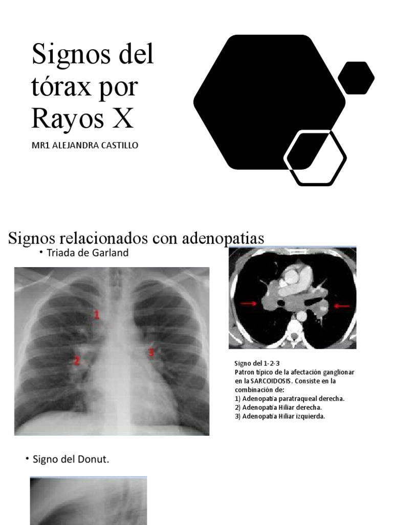 Signos Radiológicos del Tórax | PDF | Pulmón | Corazón