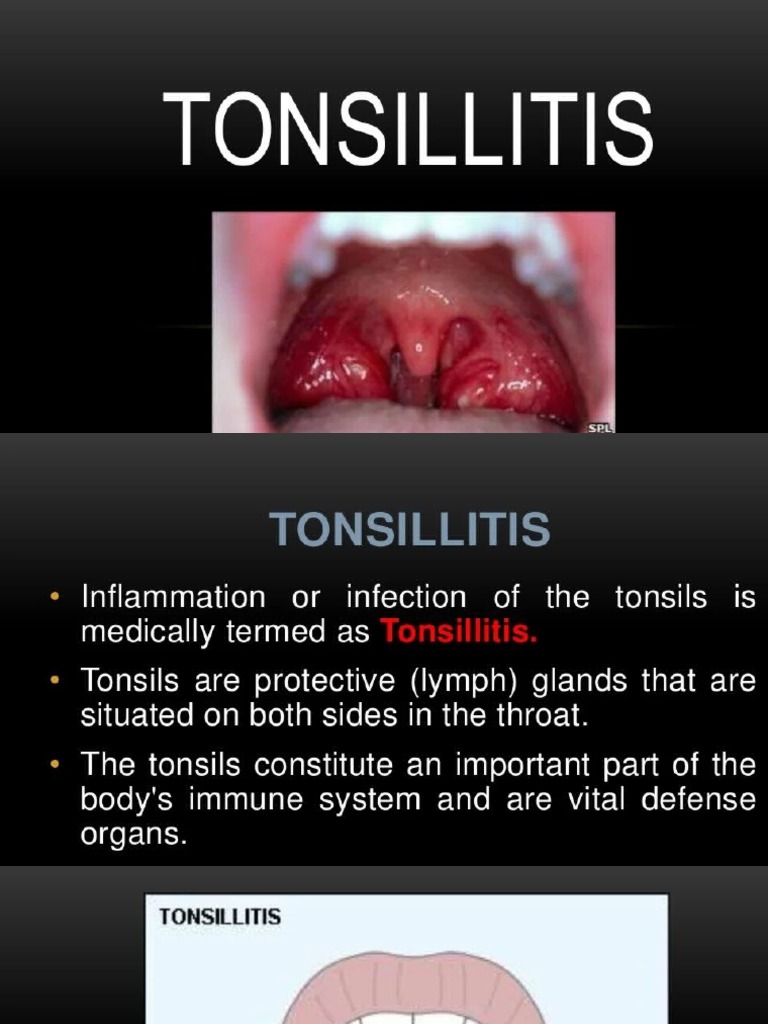 Tonsillitis | PDF