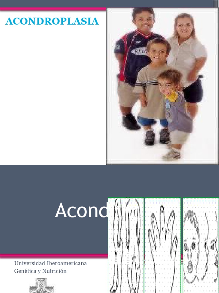Acondroplasia: Aspectos Genéticos y Cuidados | PDF | Enfermedades y ...