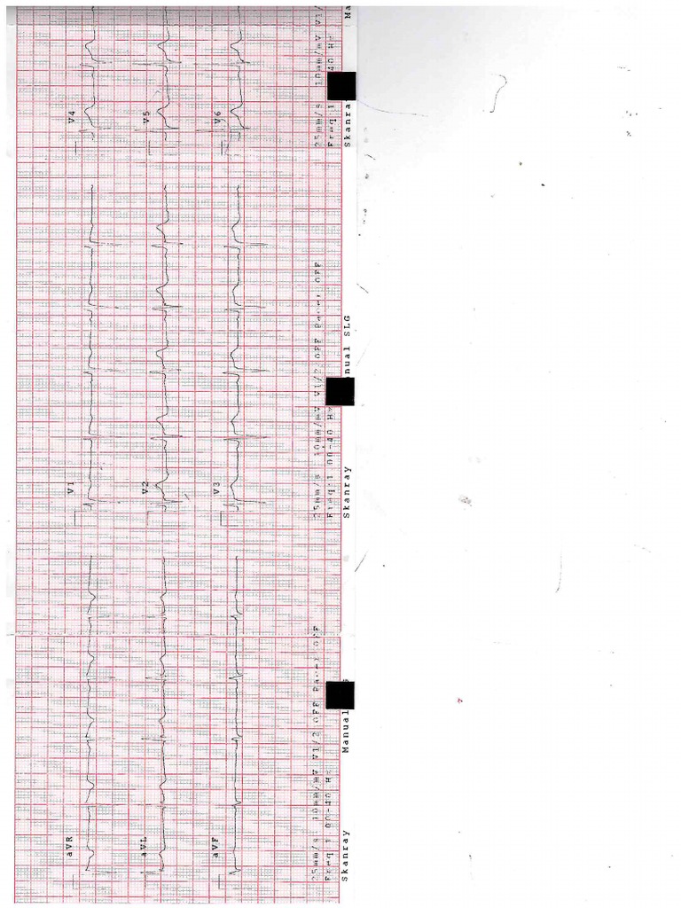 Ecg 2 | PDF