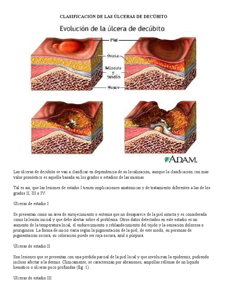 Ulceras Decubito | PDF