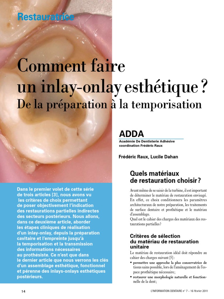 Comment Faire Uninlay-Onlay Esthetique | PDF | Fragilité | Matériau ...