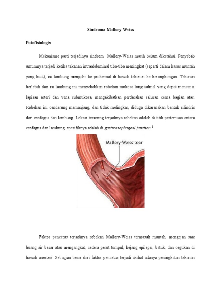Mallory Weiss Syndrome-1 Rev | PDF