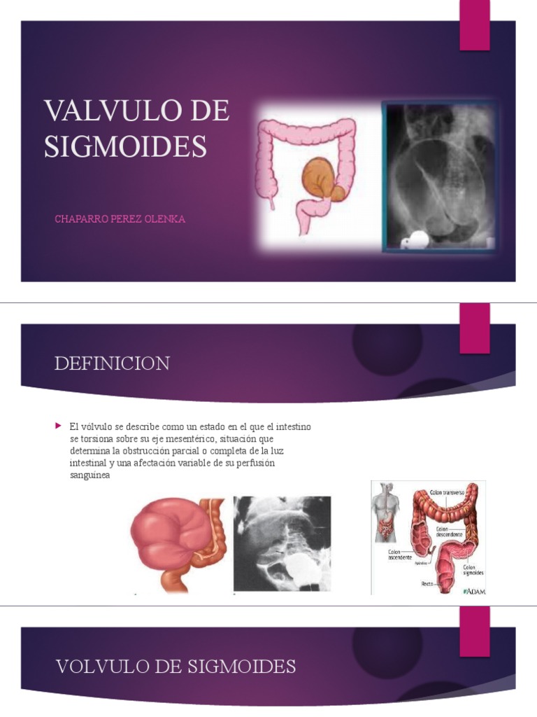 Vólvulo de Sigmoides: Diagnóstico y Tratamiento | PDF | Intestino ...