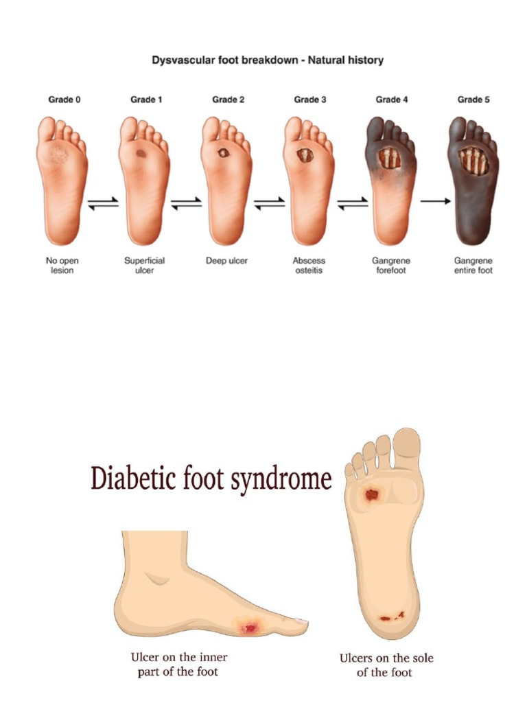 Pictures of Diabetic Amputations | PDF