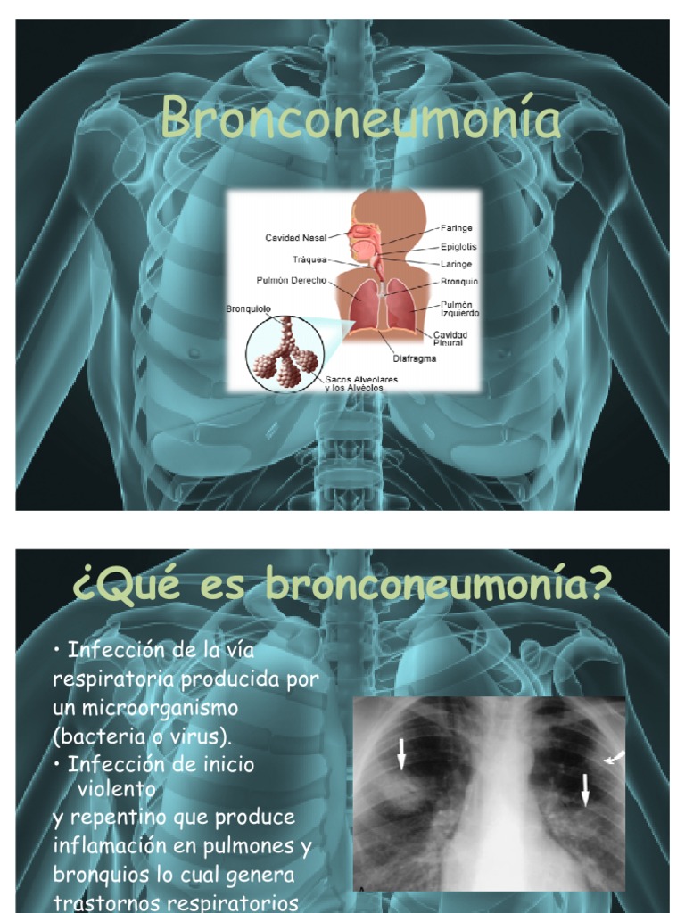 _Bronconeumonía.pptx_