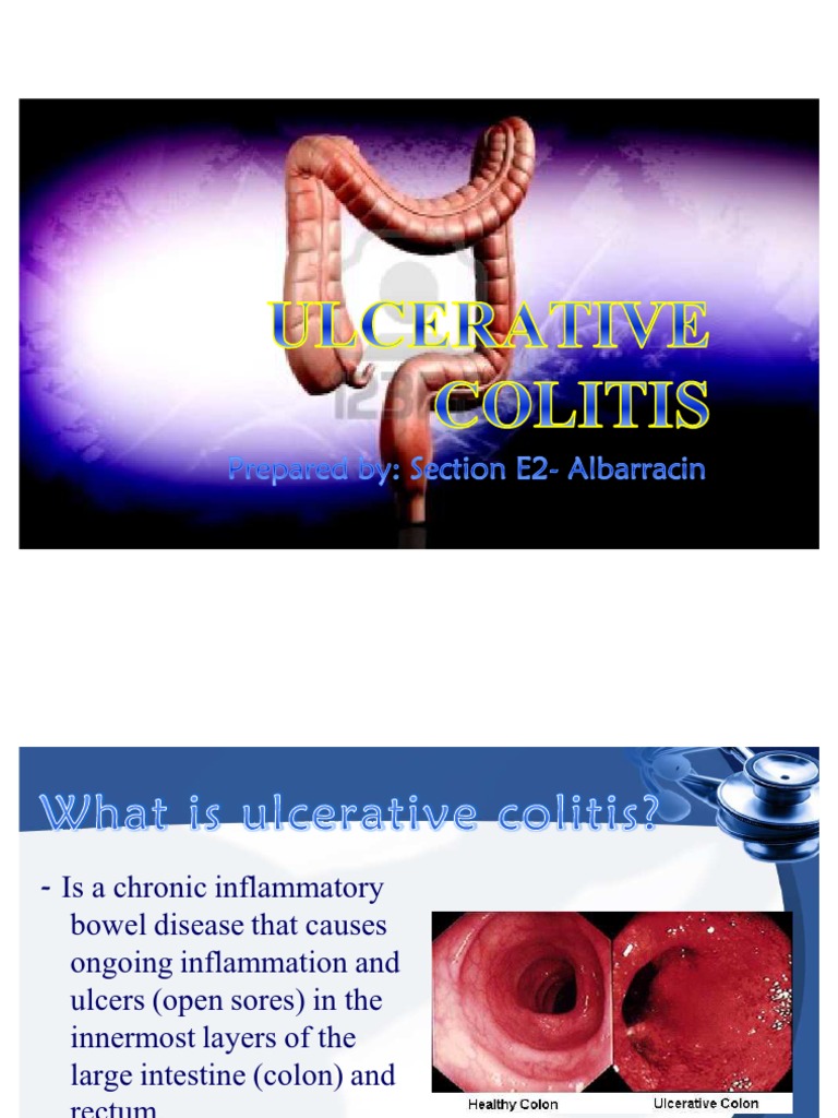 Ulcerative Colitis | PDF